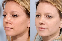 Skin Tag Removal in Dubai & Abu Dhabi | Cost & Deals