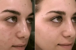 eMatrix Treatment Dubai | Skin Resurfacing & Scar Reduction